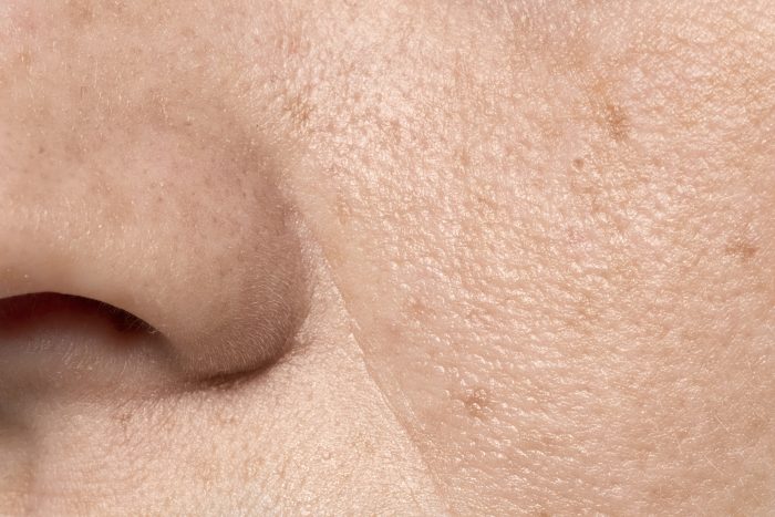 Chemical Peels for Skin: Uses, Benefits, and Types