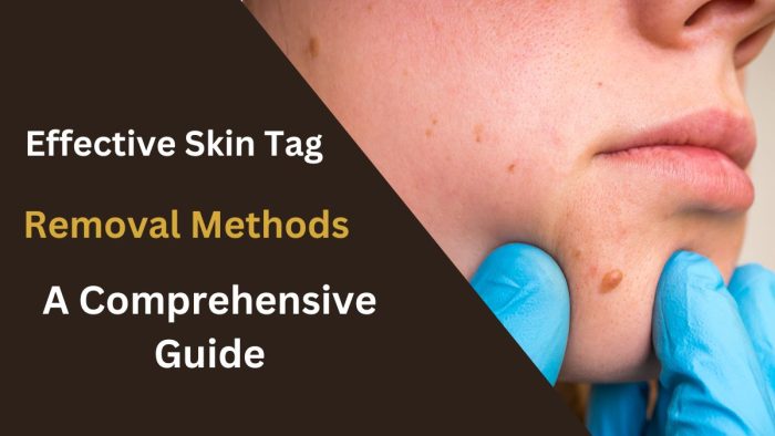 Effective Skin Tag Removal Methods: A Comprehensive Guide